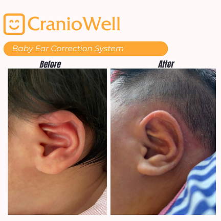 CranioWell Medical Technology | Baby Ear Deformity Corection System